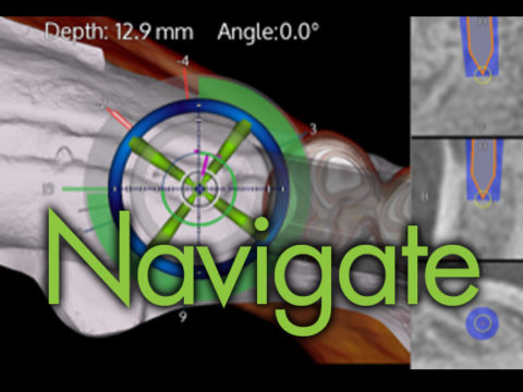 Learn More about the X-Guide Dynamic 3D Navigation System