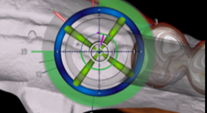 Learn More about the X-Guide Dynamic 3D Navigation System