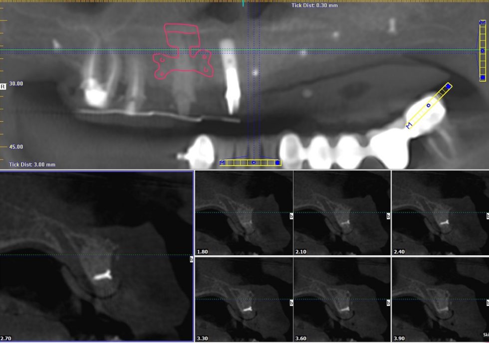 Bone Grafts, How X-Guide Can Assist with you Implant Placing