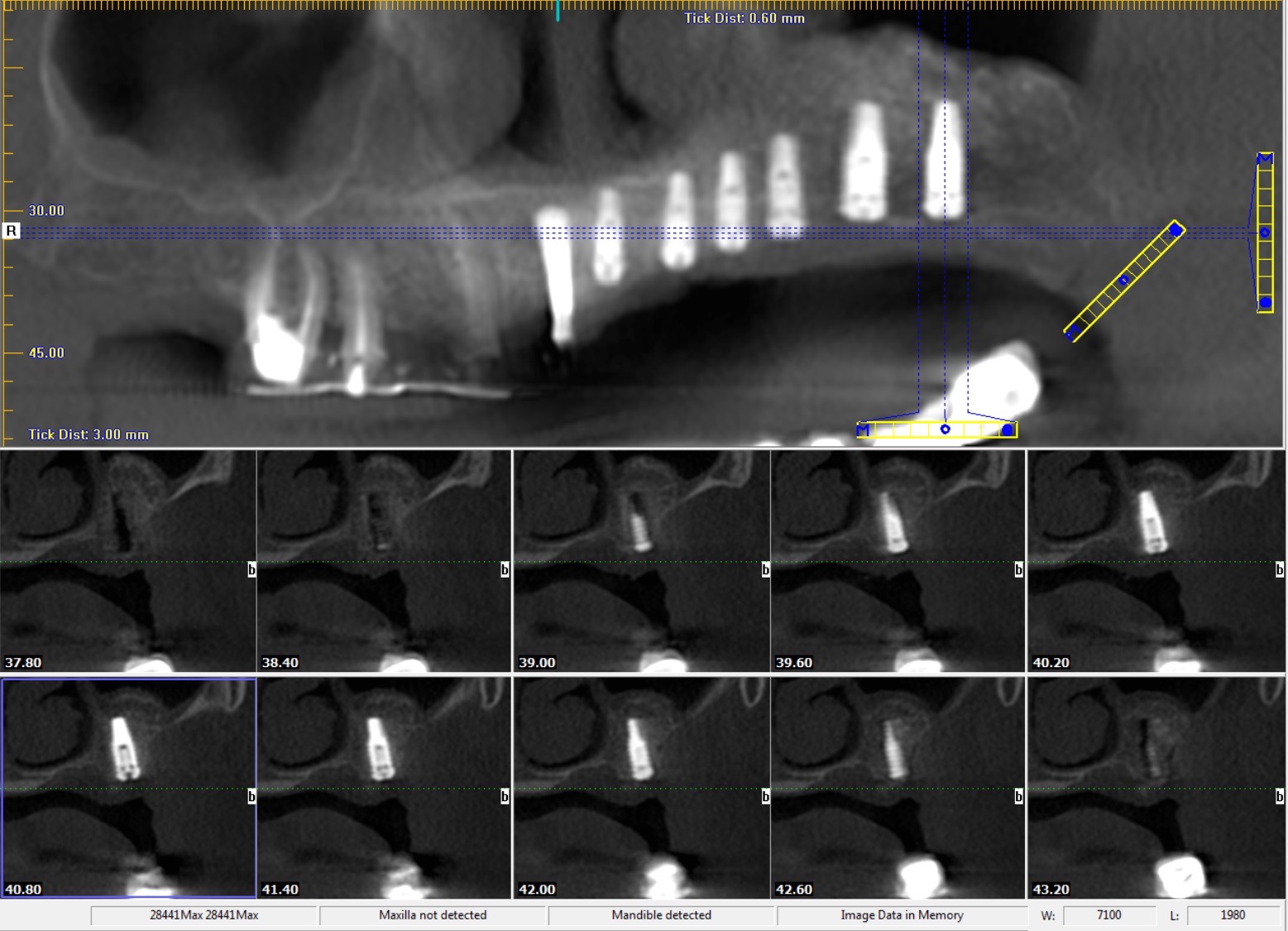 Learn More! Advanced Placement Solutions for Implants with X-Nav Tech