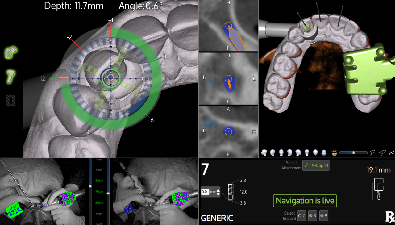 Learn More! Advanced Placement Solutions for Implants with X-Nav Tech