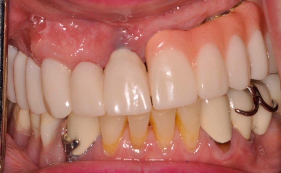 Learn More! Advanced Placement Solutions for Implants with X-Nav Tech