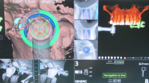 Learn More! Advanced Placement Solutions for Implants with X-Nav Tech