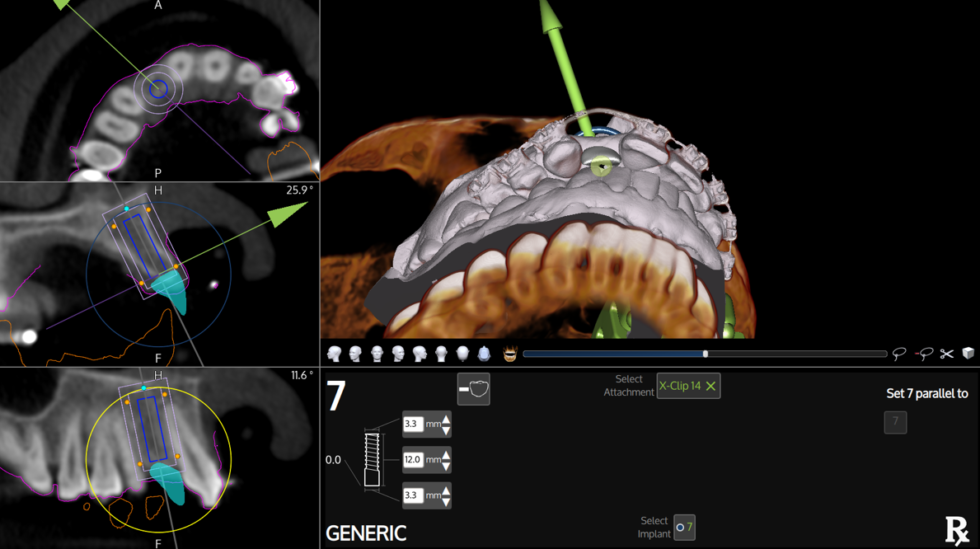 Learn More! Advanced Placement Solutions for Implants with X-Nav Tech