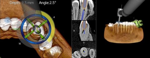X-Guide ‣ for Minimally Invasive Endodontic Treatments
