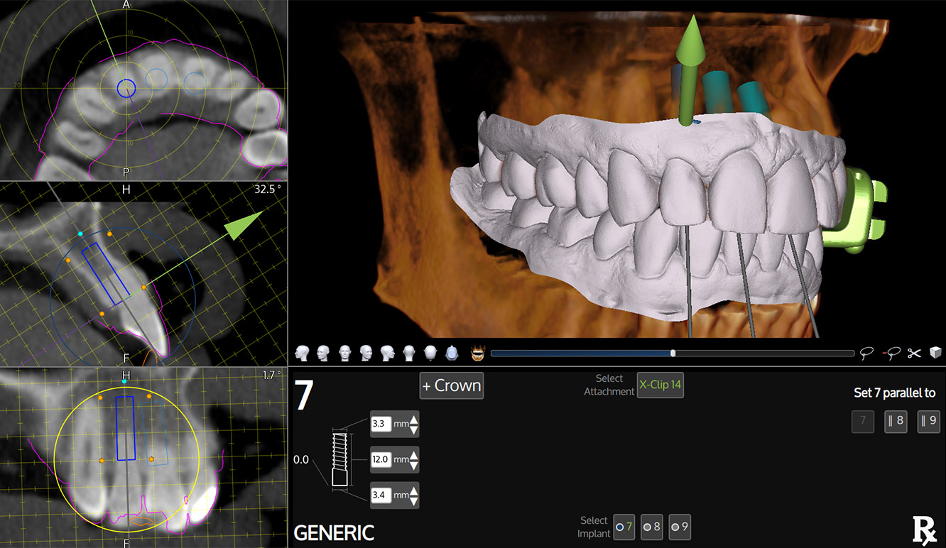 Sinus Elevation Procedures are Easy Navigated with X-Guide